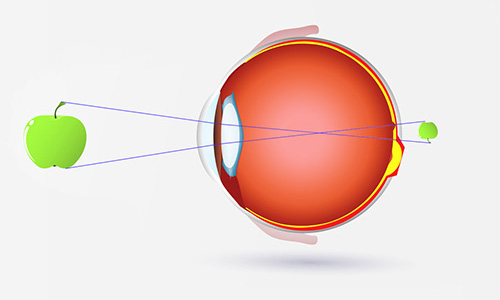 Les principaux troubles visuels : causes et conséquences
