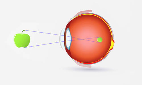 Les principaux troubles visuels : causes et conséquences